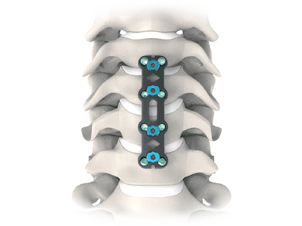 Cervical Stabilization — Medtech