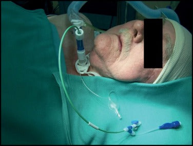 Airway management in thoracic anesthesia — Medtech