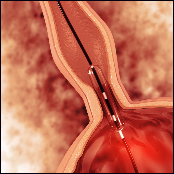 Precision Balloon Dilation Catheters for Cardiologists | Medtech