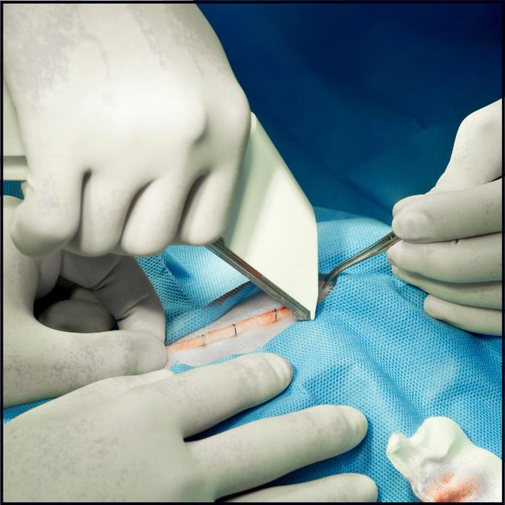 Mechanical Staplers for Improved Surgical Precision | Medtech