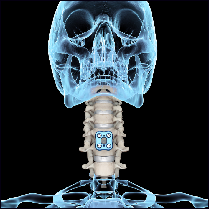 Cervical Fixation Solutions for Neurosurgeons | Medtech