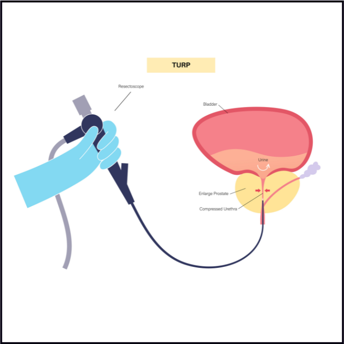 Transurethral Resection TUR-P Instruments for Urologists | Medtech