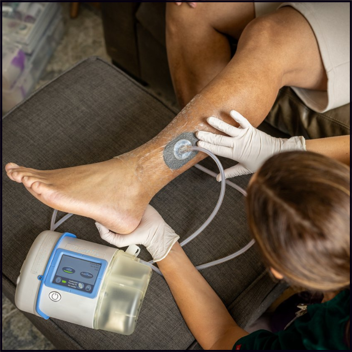 Vac Dressing: Efficacy, Safety & Innovation for Surgeons | Medtech