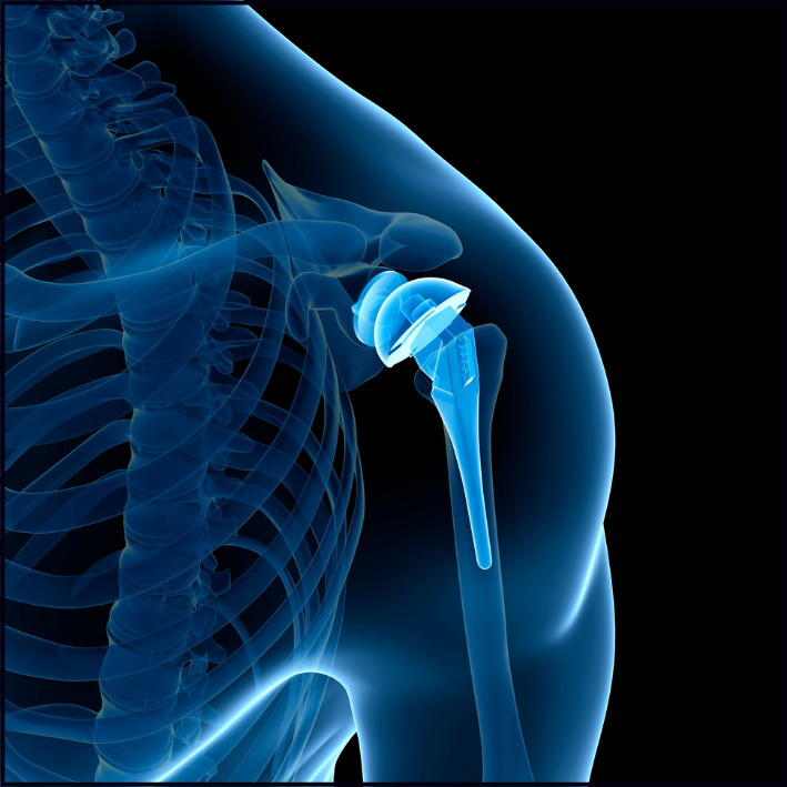Advanced Shoulder Arthroplasty Solutions for Surgeons | Medtech